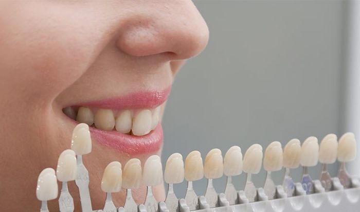 ¿Cómo elegir el color de tus dientes?